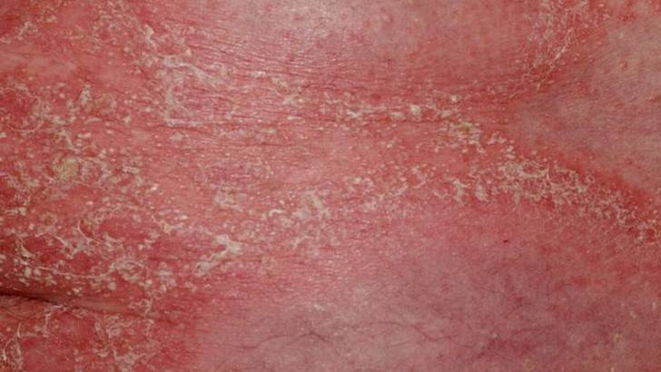 pustular psoriasis