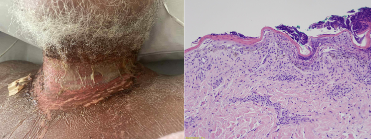 When Lightning Strikes: A Case Study of Staphylococcal Scalded Skin ...