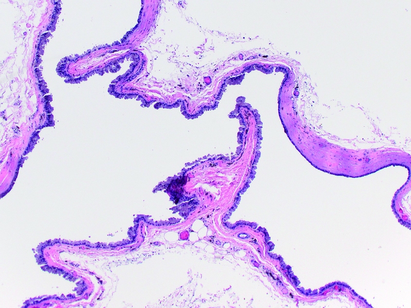 Apocrine Hidrocystoma of the Axilla - PracticalDermatology