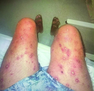 Case Study: Recurrent Generalized Pustular Psoriasis - PracticalDermatology