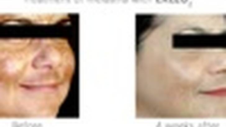 EXELO2 by Quantel Derma