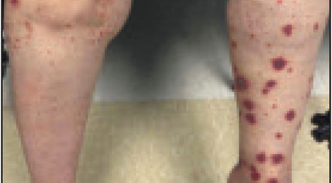 Turmeric, Curcumin, and Curcuminoids: A Dermatologic Review