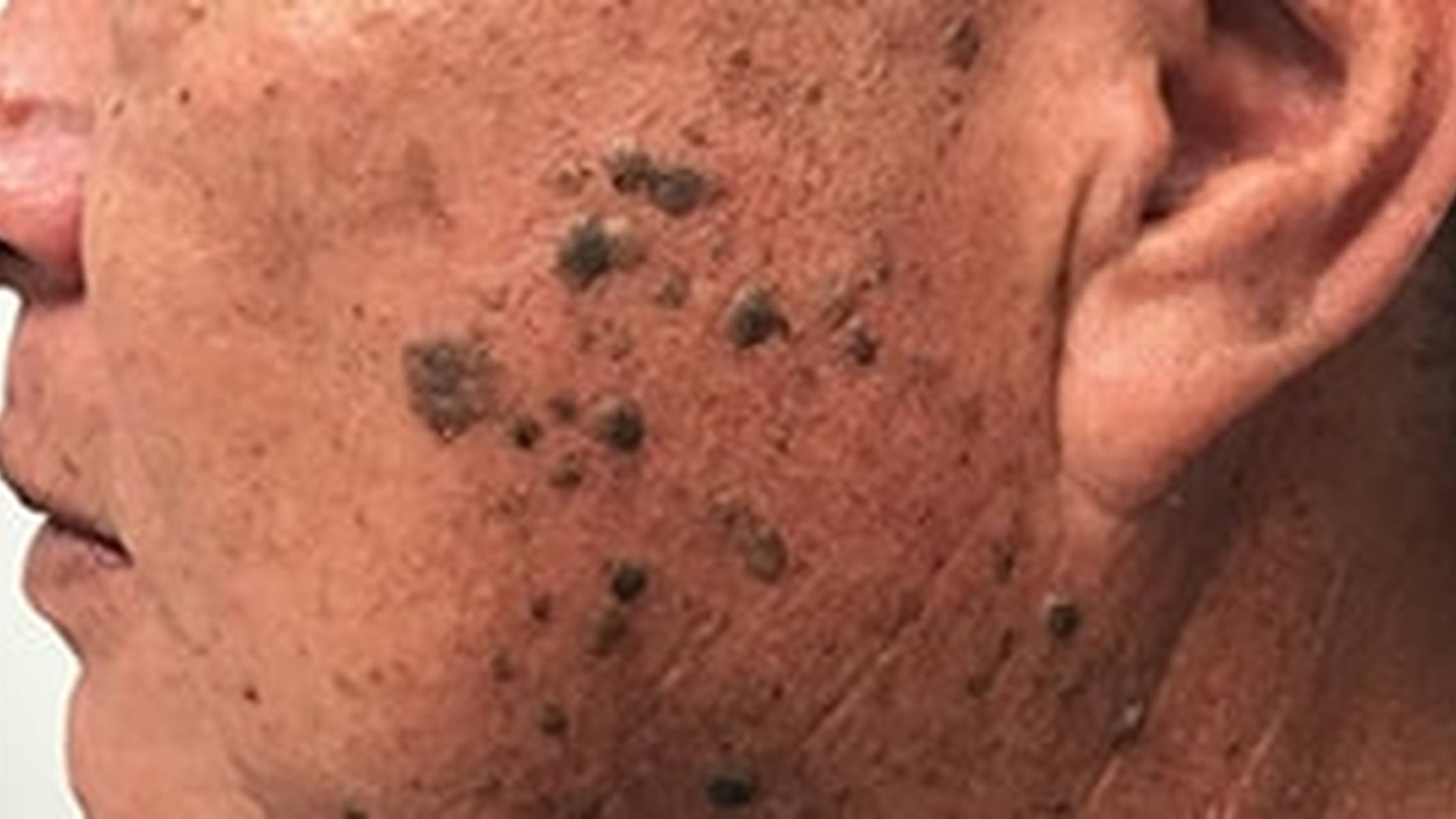 New Options for the Treatment of Extensive Seborrheic Keratosis