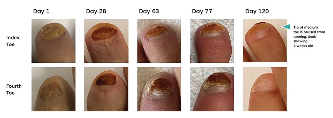 New Hope for Patients with Onychomycosis - PracticalDermatology