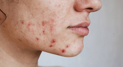 Rosacea: A Closer Look at the Latest Treatment Options