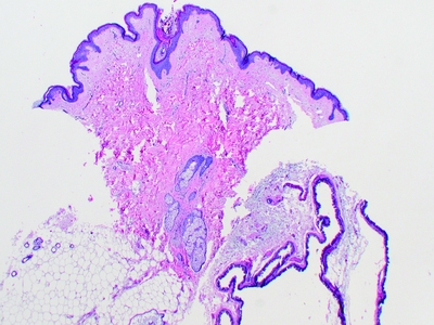 Apocrine Hidrocystoma of the Axilla - PracticalDermatology
