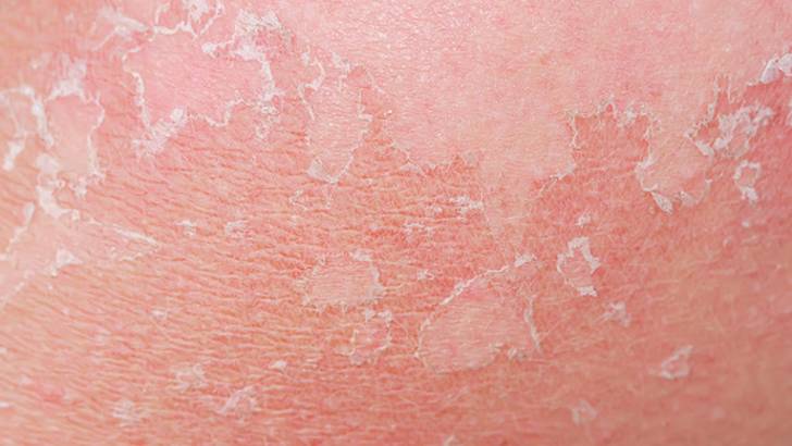 Monoclonal Antibodies for Restoring a Healthy Skin Microbiome in Atopic ...