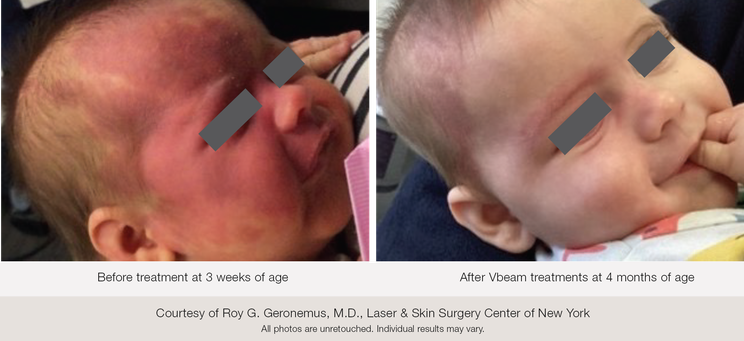 FDA Clears Candela's Vbeam 595 nm Pulsed Dye Laser for the Treatment of ...