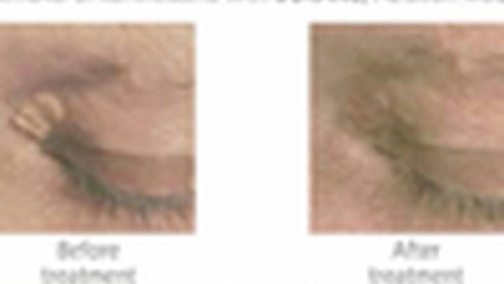 BURANE, Er:YAG Laser System by Quantel Derma
