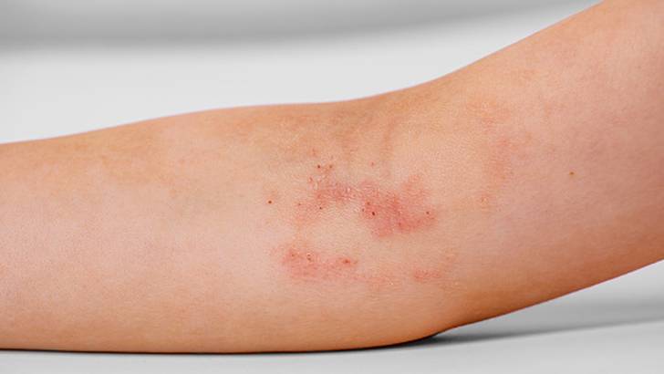 Topical corticosteroids, calcineurin inhibitors in AD