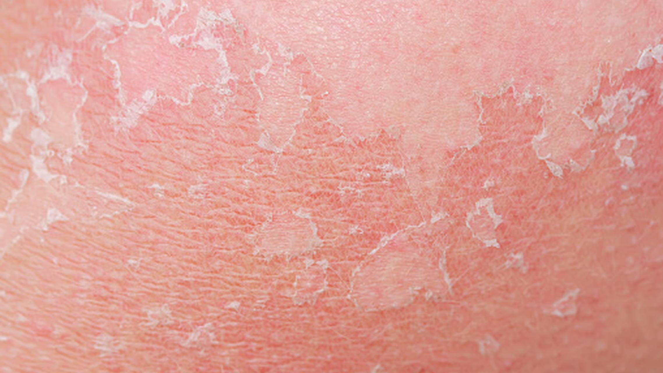 Lose Your Inhibitions: Expanding Use of JAK Inhibitors