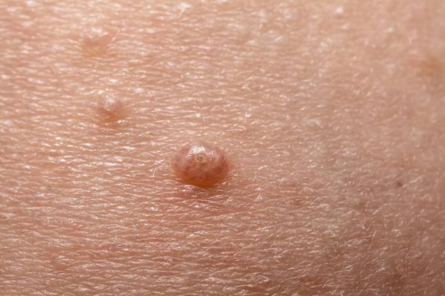 FDA Approves Verrica Pharmaceuticals’ YCANTH for Molluscum Contagiosum ...