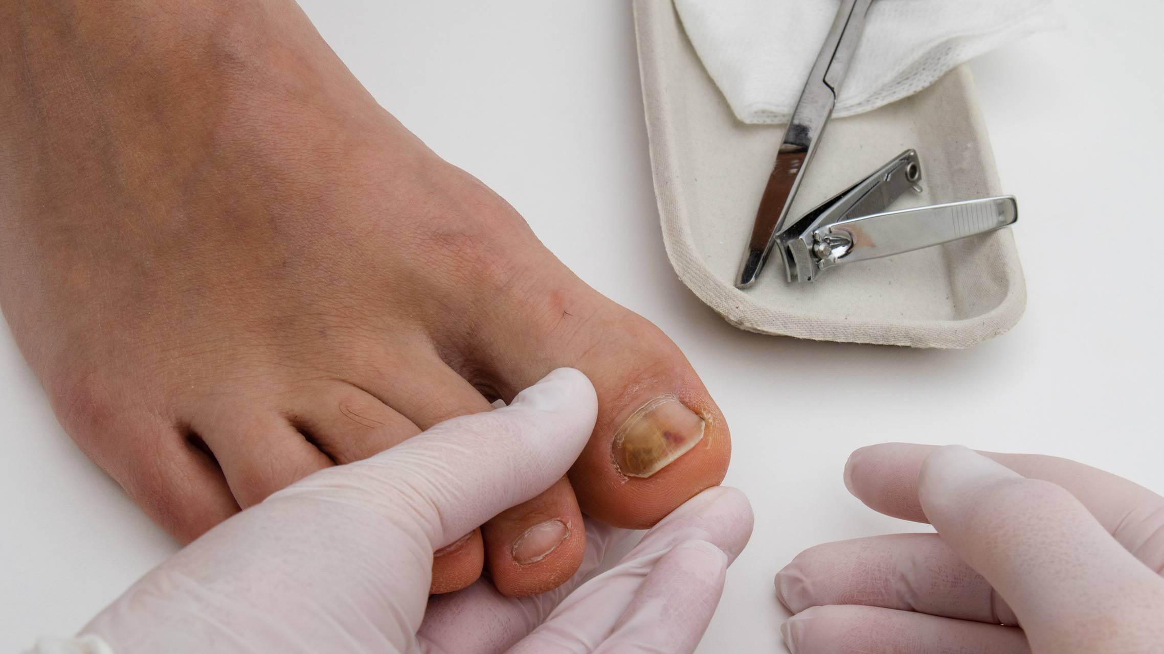 New Hope for Patients with Onychomycosis - PracticalDermatology