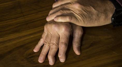 Monitoring Biologic Therapy In Psoriasis: A Primer