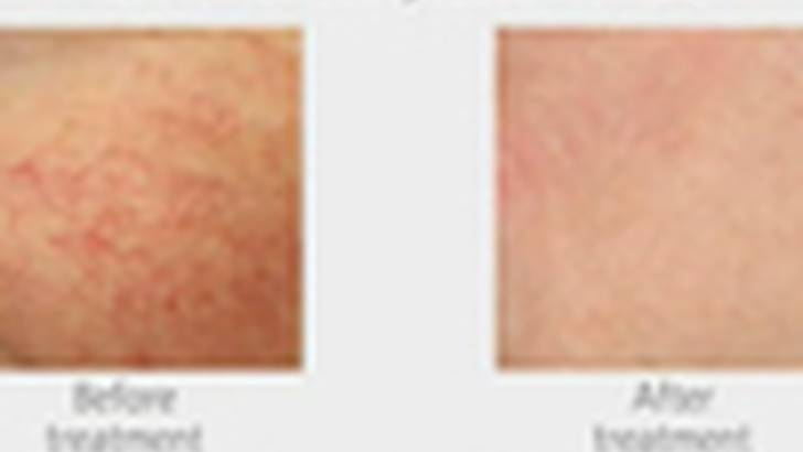 IDAS, LBO Laser System by Quantel Derma