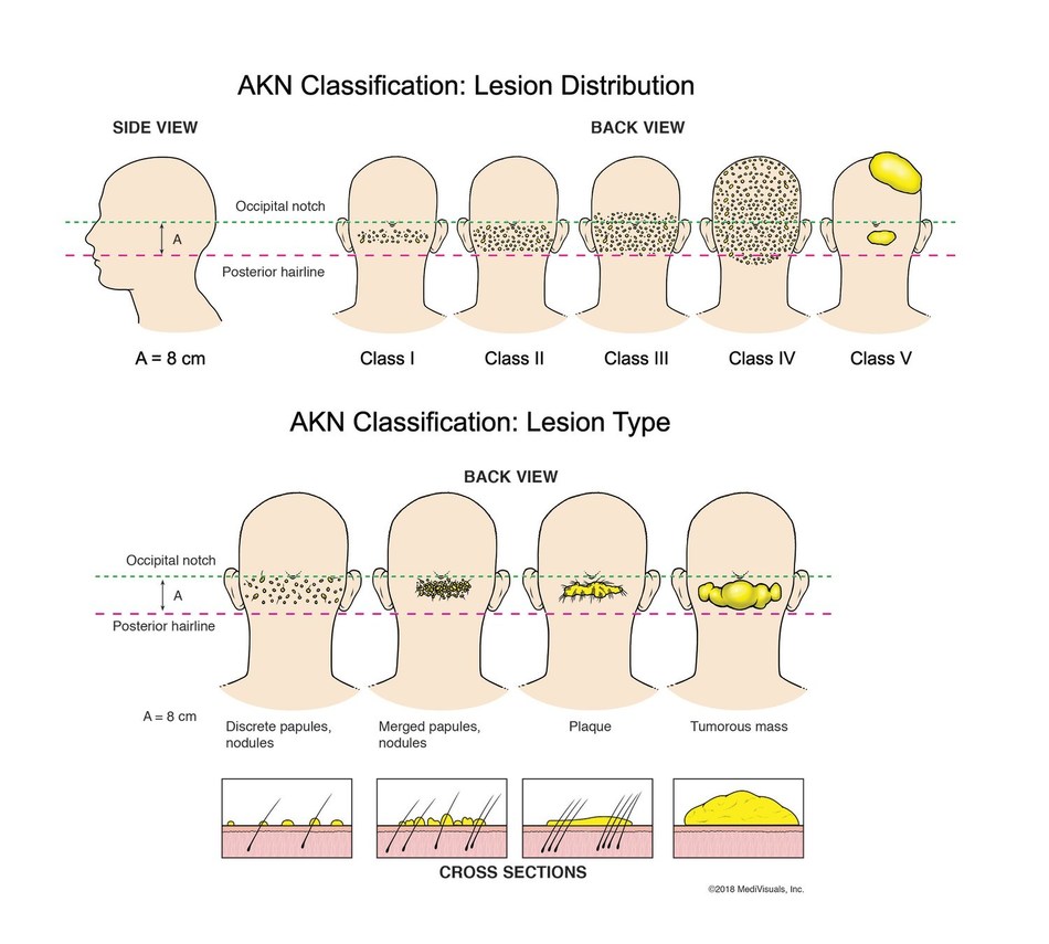 New AKN Classification System May Improve Treatment ...