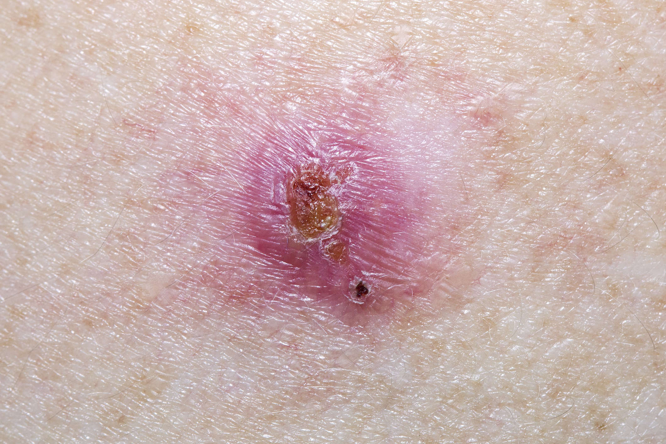 Simple Laser Treatments May Help Prevent Nonmelanoma Skin Cancer ...
