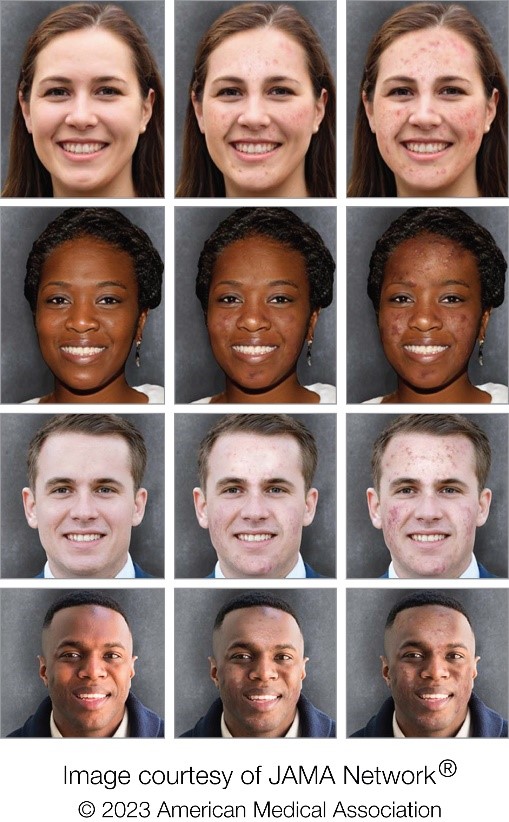Study: Individuals With Acne Face Social and Professional Stigma ...