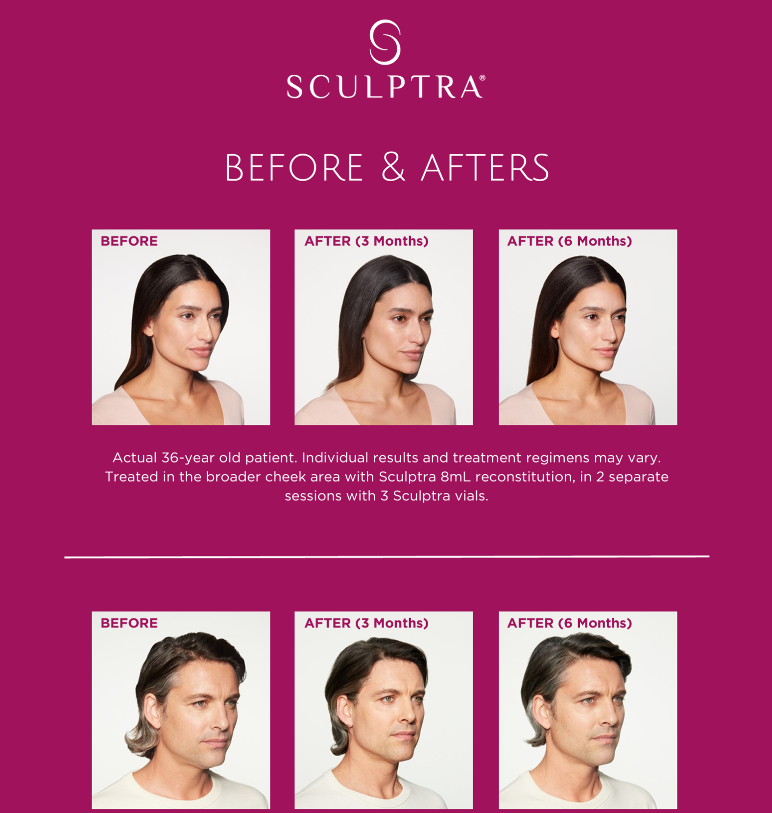 Galderma's Sculptra Now FDA Approved for Cheek Wrinkles ...