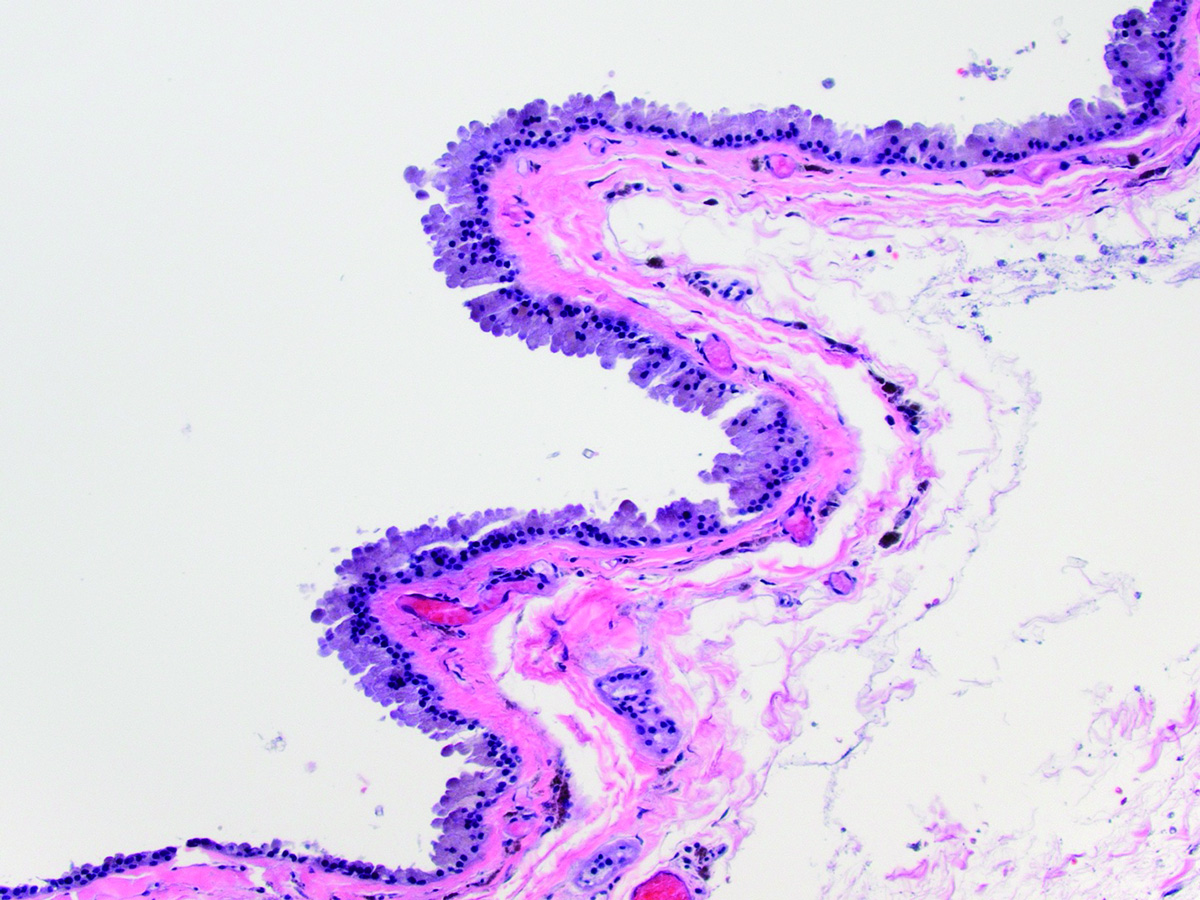 Apocrine Hidrocystoma of the Axilla - PracticalDermatology