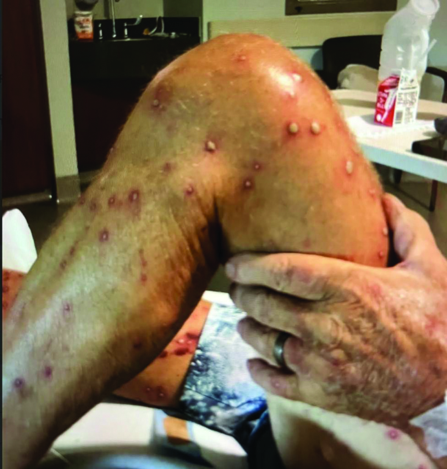 Case Study: Recurrent Generalized Pustular Psoriasis - PracticalDermatology