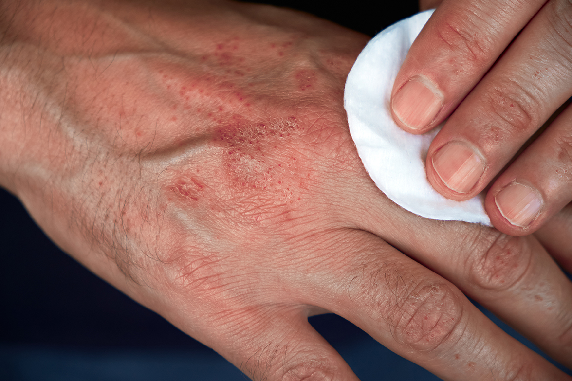 Therapeutic Options for Chronic Hand Eczema