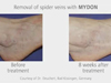 MYDON by Quantel Derma - Perfect for Spider Veins