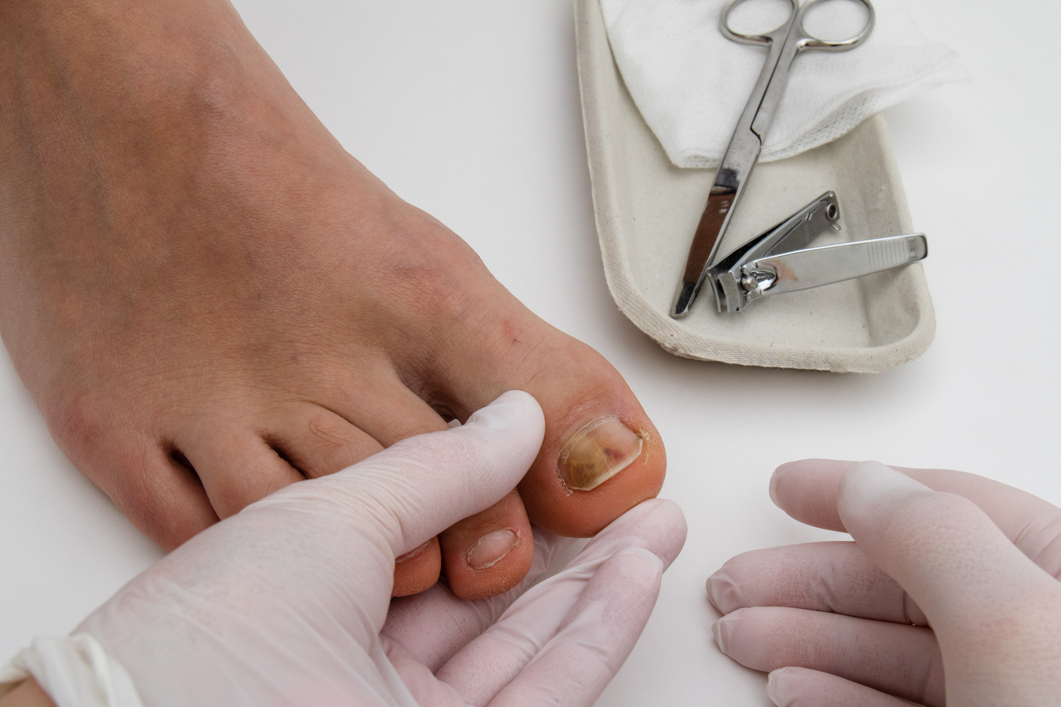 New Hope for Patients with Onychomycosis - PracticalDermatology