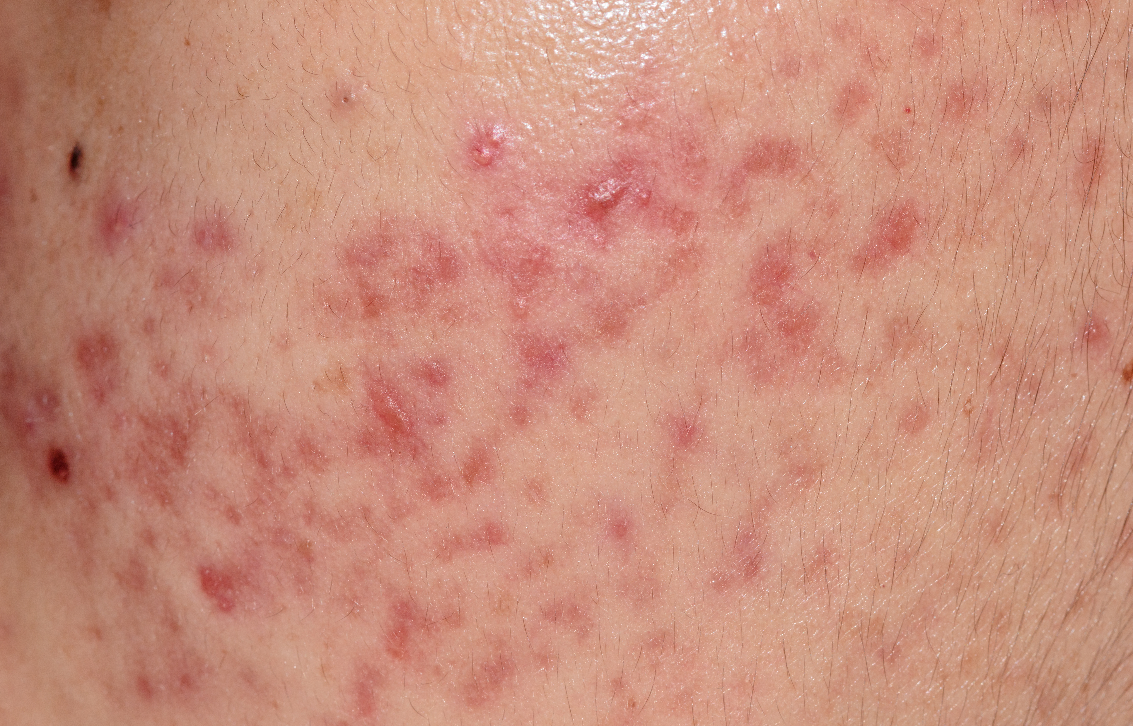 Impact of Clascoterone Topical Cream