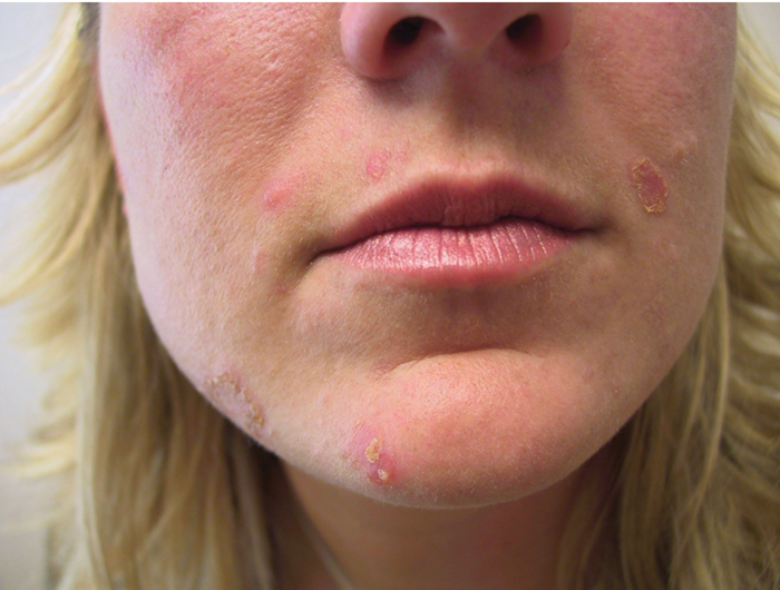 Impetigo: An Unconventional Case Report - PracticalDermatology