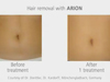 ARION, Alexandrite Laser System by Quantel Derma