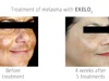 EXELO2 by Quantel Derma